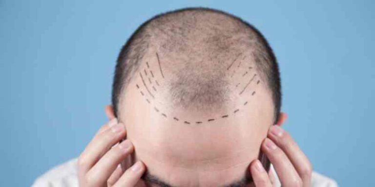 FUE Hair Transplant: Benefits, Procedure & Expert Tips